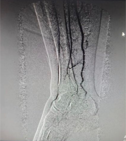 Surgical Procedure - Vascular Care and Treatment in California
