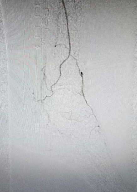 Surgical Procedure - Vascular Care and Treatment in California