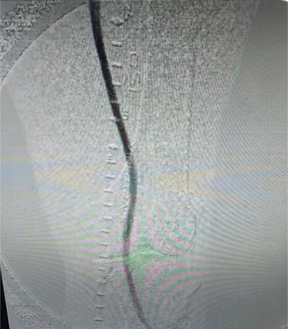 Surgical Procedure - Vascular Care and Treatment in California