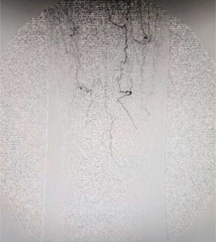 Surgical Procedure - Vascular Care and Treatment in California